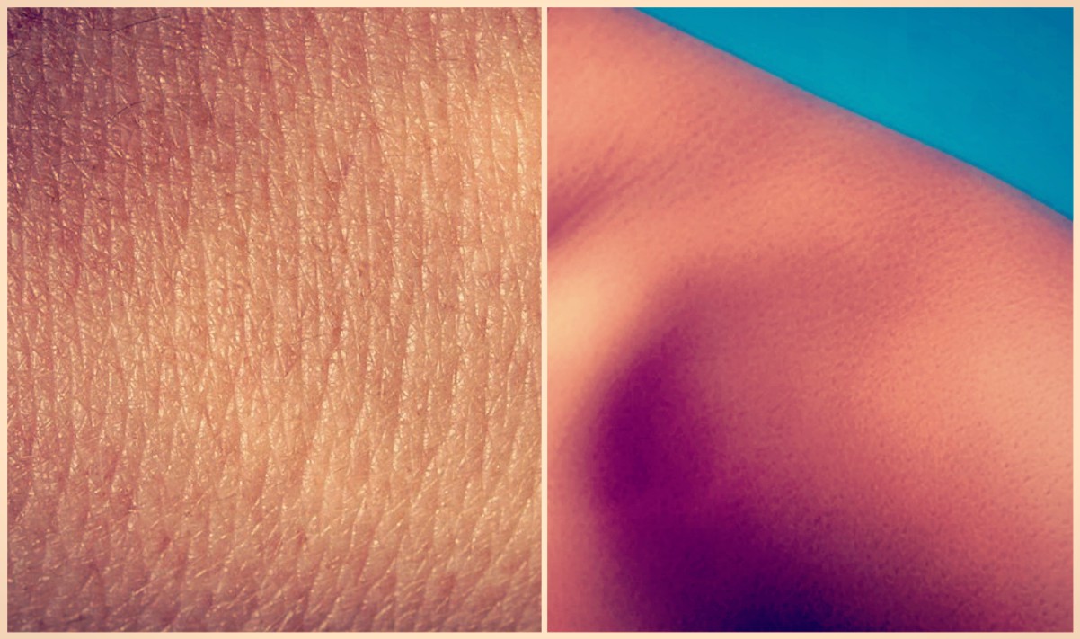 Skin Color Protein Used to Better Evaluate Skin Cancer | Cancer