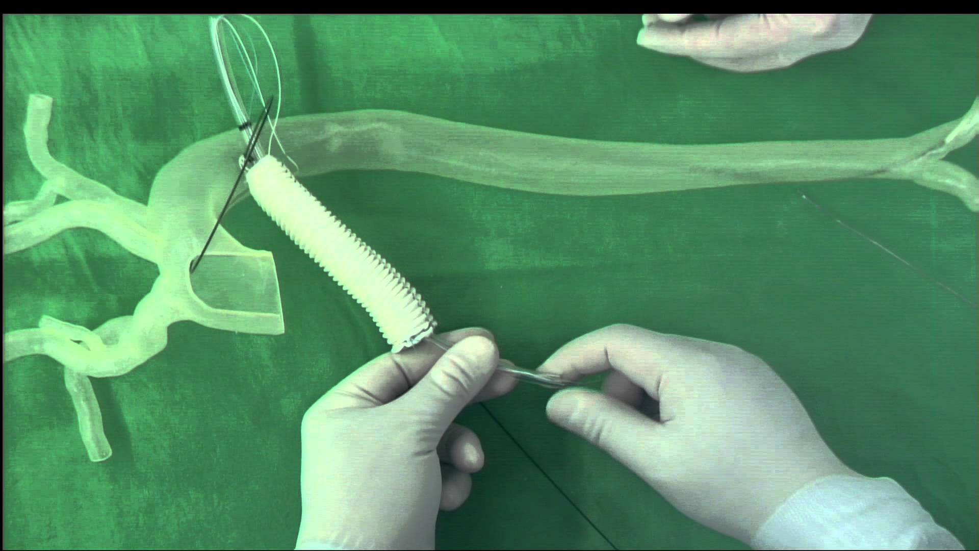 How A High-Risk Heart Surgery Changed in 10 Years | Health And Medicine