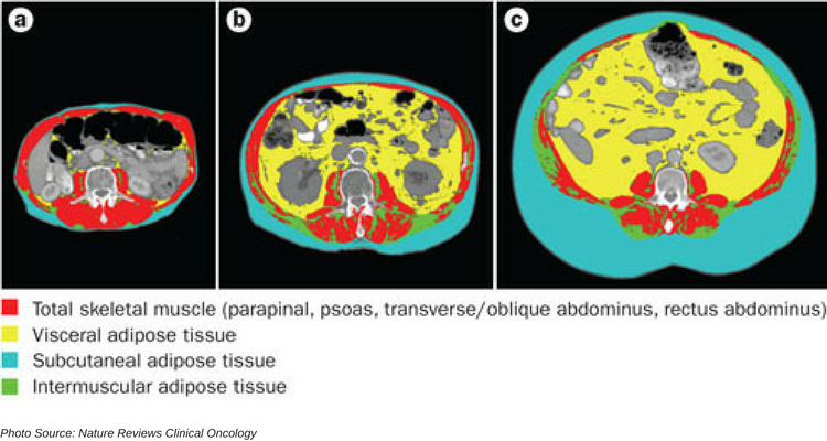 Low Muscle Mass Could Be Affecting Breast Cancer Survival | Cancer