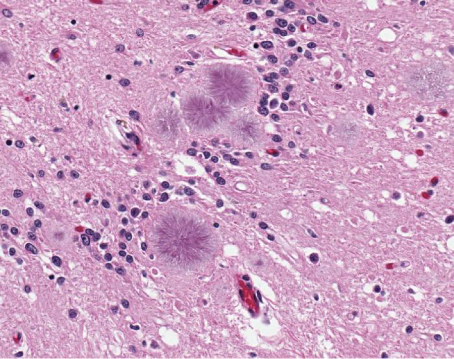 What Infectious Proteins Do in the Brain | Clinical And Molecular Dx