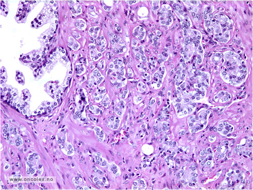 New Viable Drug Target for Prostate Cancer | Drug Discovery And Development