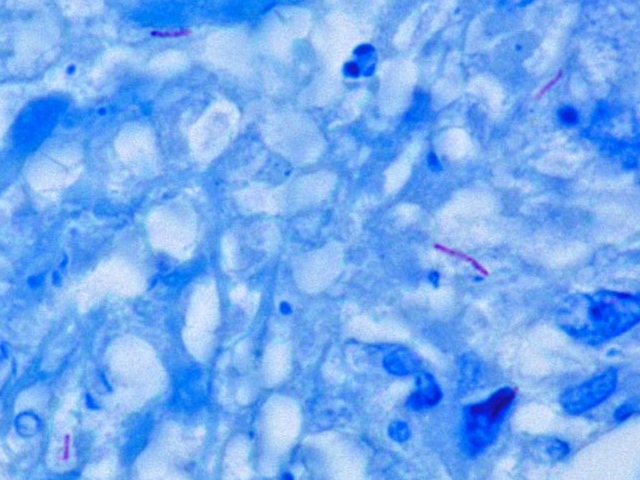 Mycobacterium Tuberculosis Playing Games with the Immune System ...