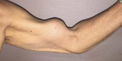 Diagnosed: What Really Caused this Man's Popeye Arm? | Clinical And ...