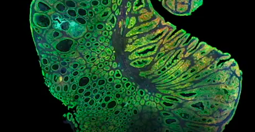 A Look at the Tumor Microenvironment | Videos