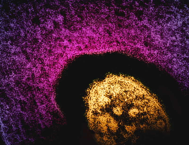 Measles Cases are Soaring Around the World | Microbiology