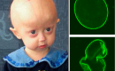 Diagnosing and Treating An Extremely Rare Genetic Disease: Progeria