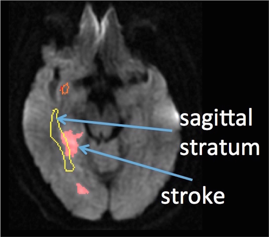Oh, Joy: Brain's Sarcasm Center Found | Neuroscience