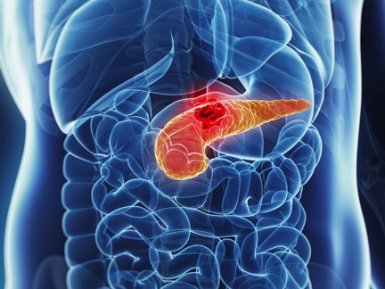 New 5-Gene Biomarker Panel Detects Early Stage Pancreatic Ca | Clinical ...