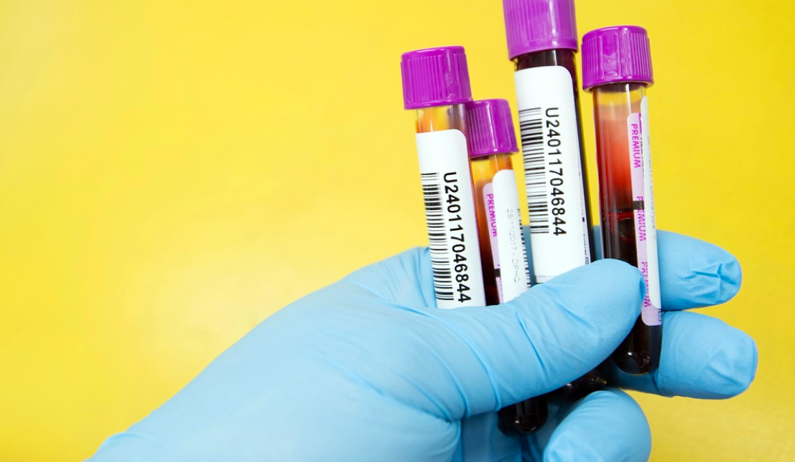 DNA Methylation Patterns may Work as Parkinson's Biomarkers | Clinical ...