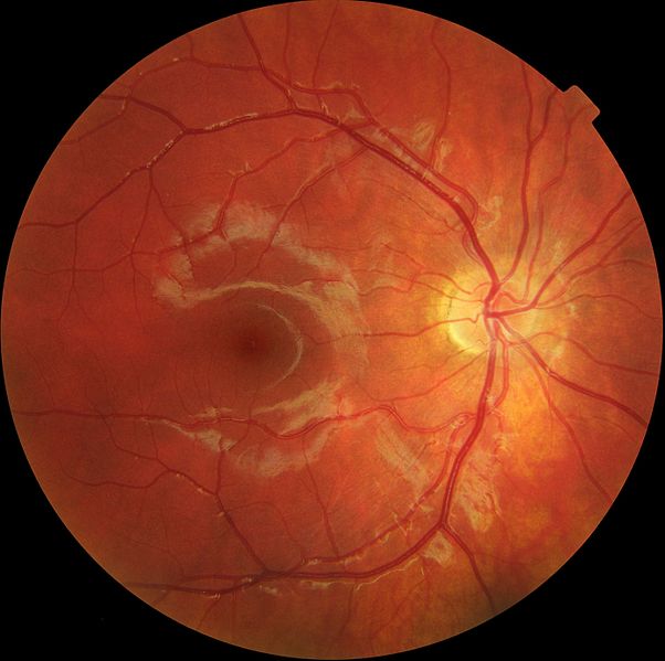 Stopping Inflammation Early to Prevent Blindness From Macular ...