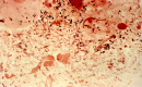 Plant-Based Compounds 'Starve' Prostate Cancer Cells