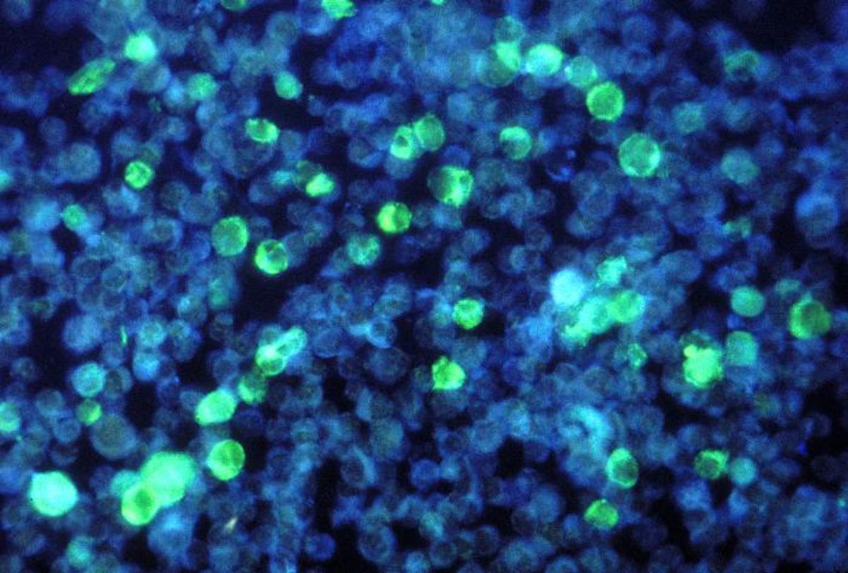 How a Gene Variant Raises the Risk of Multiple Sclerosis | Cell And ...