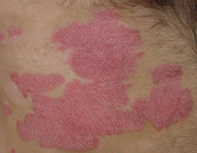 New Treatment for Psoriasis and Other Autoimmune Diseases | Immunology