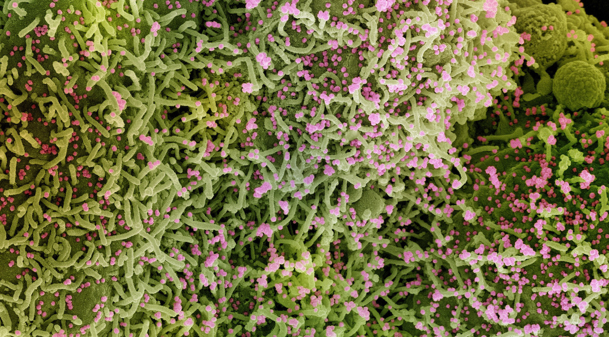 Many Variants of the Virus Can Hide Away in COVID-19 Patients | Immunology