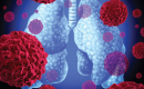 Proposed New Genetic-Clinical Risk Grouping Model for Prostate Cancer