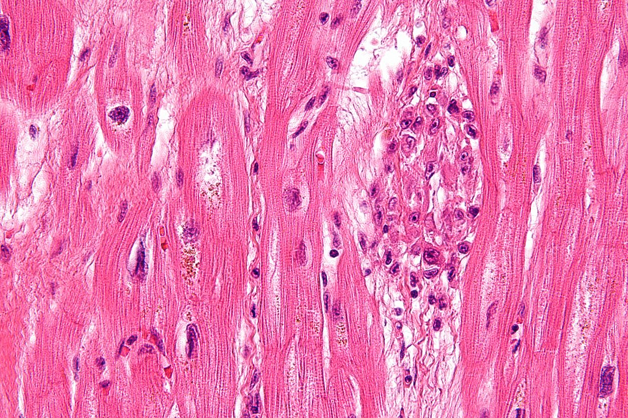 Rheumatic Heart Disease in 1990: Then and Now | Cardiology