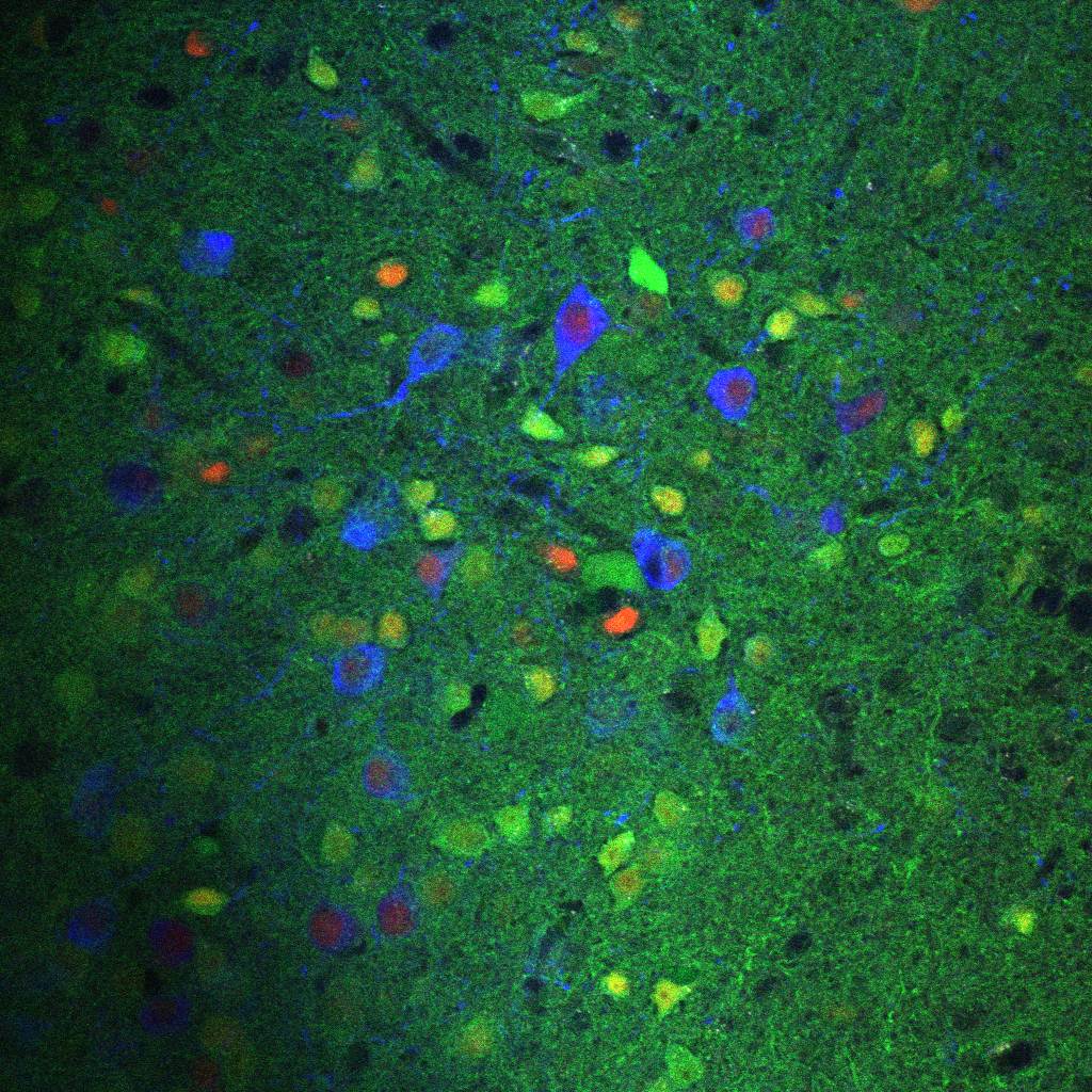 Ketamine's Restructures the Brain | Neuroscience