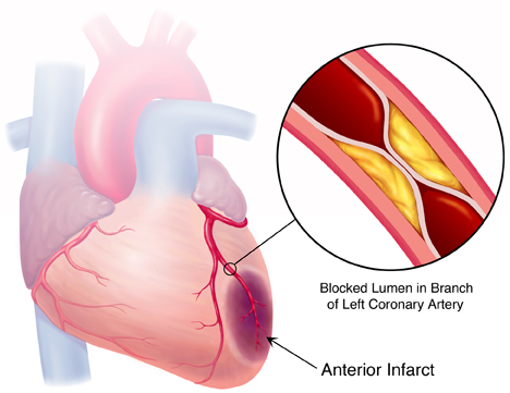 Preventing Heart Failure After Acute Myocardial Infarction | Cardiology