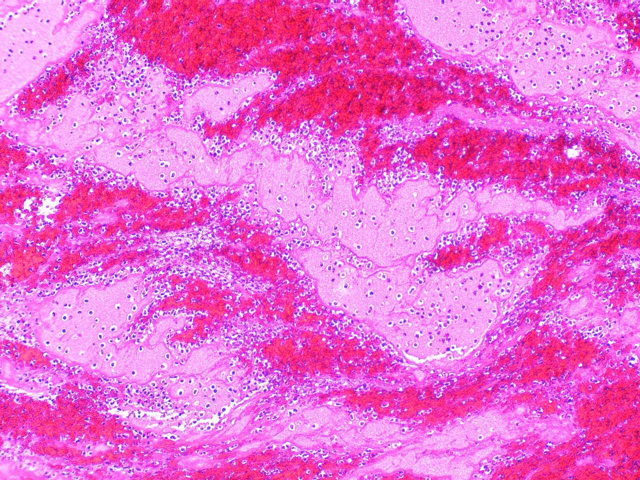 A Vaccine for Heart Disease? | Immunology