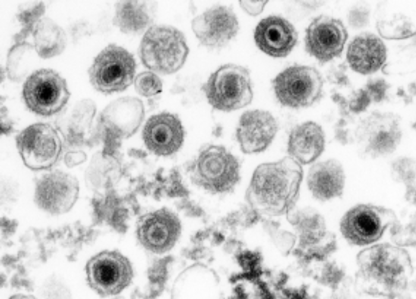 Epstein-Barr Virus Symptoms Driven By Host Immune Response | Microbiology
