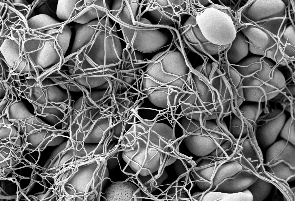 Molecular Pathways of MPN Exposed | Drug Discovery And Development