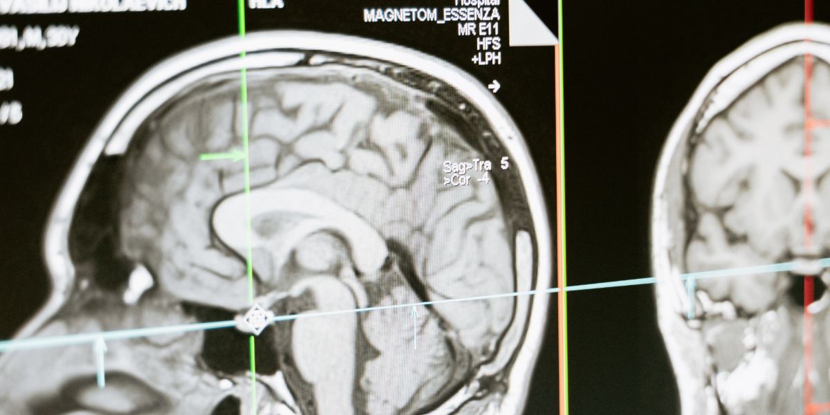 Low Memory Test Scores Linked to Alzheimer's Biomarkers | Neuroscience