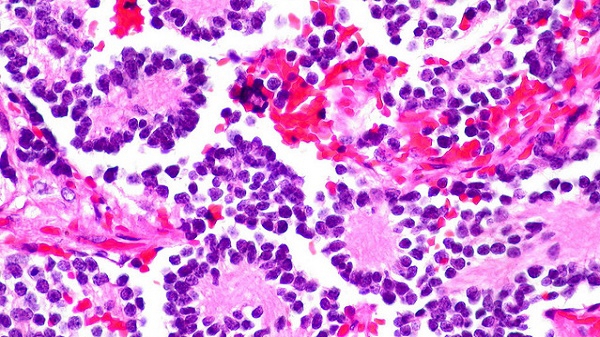 Shedding Light on Chemo | Cancer