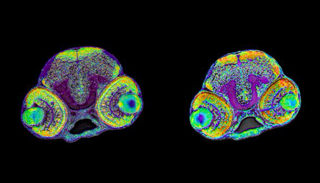 Why Mutations in RRP7 Cause a Congenital Brain Disorder | Genetics And ...
