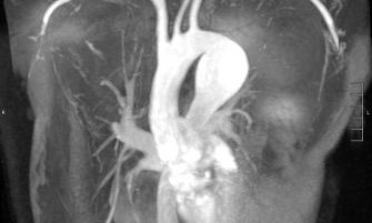 Surgeons Highly Recommend This Surgery for Atrial Fibrillation Trending ...