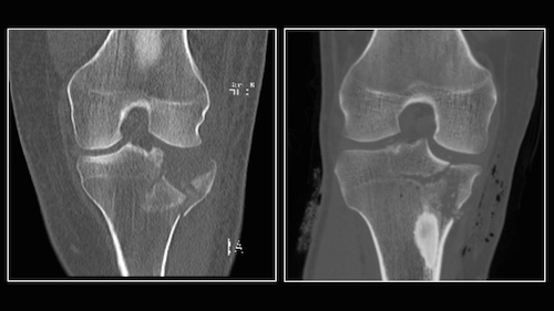 CT Scan Detects Fractures Using 14-Times Less Radiation | Health And ...