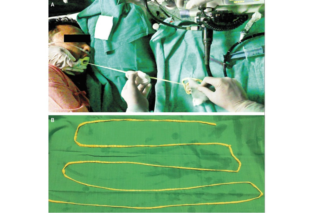 Doctors Pull 6ft Tapeworm from Man's Mouth | Clinical And Molecular Dx