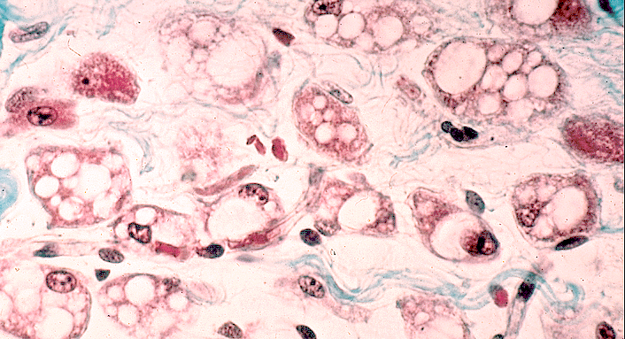 Towards an Understanding of the Role of Brown fat in Health and Disease ...