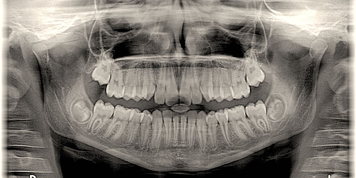 Scientists Regenerate Missing Teeth in Mice | Drug Discovery And ...