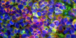 Joubert Syndrome Model Successfully Treated with Gene-editing ...