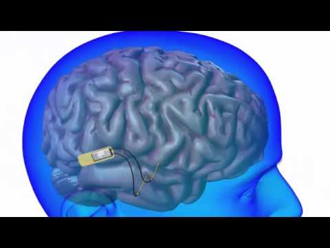 DARPA's New Brain Device | Videos