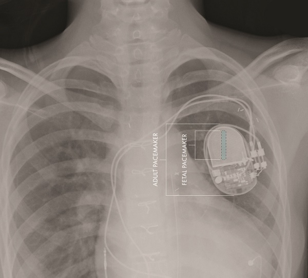 Tiny Pacemaker for Fetus | Cardiology
