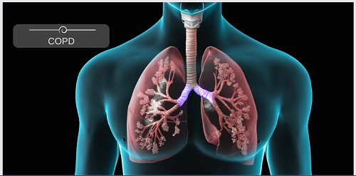 Chronic Obstructive Pulmonary Disease COPD | | Content Tag