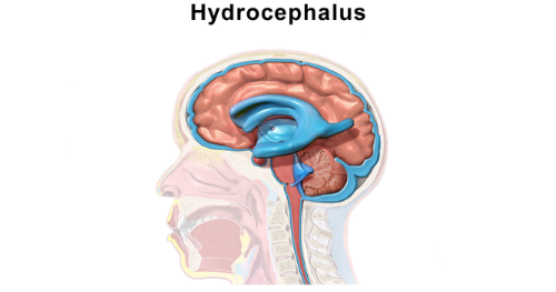 Hydrocephalus | | Content Tag