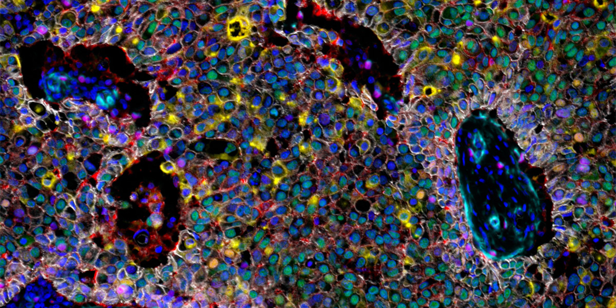 High-plex spatial proteomics workflow for enhanced breast cancer research