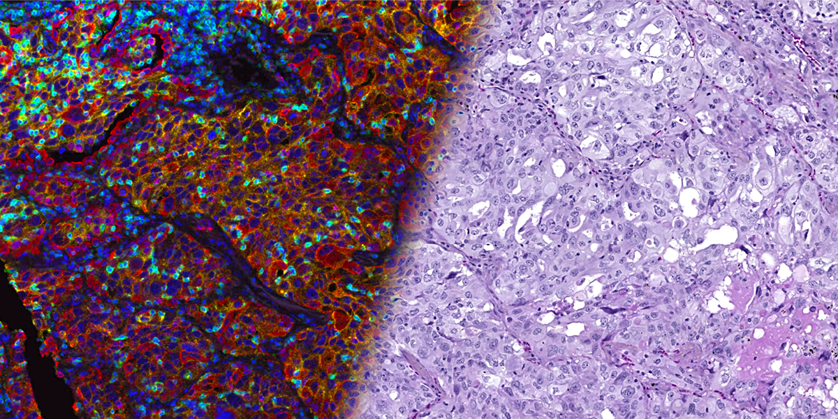 Spatial Insights from clinical biopsies: Why lymphocyte relationships ...