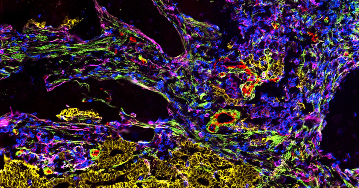 Next generation ultra high content analysis of the tumor immune ...